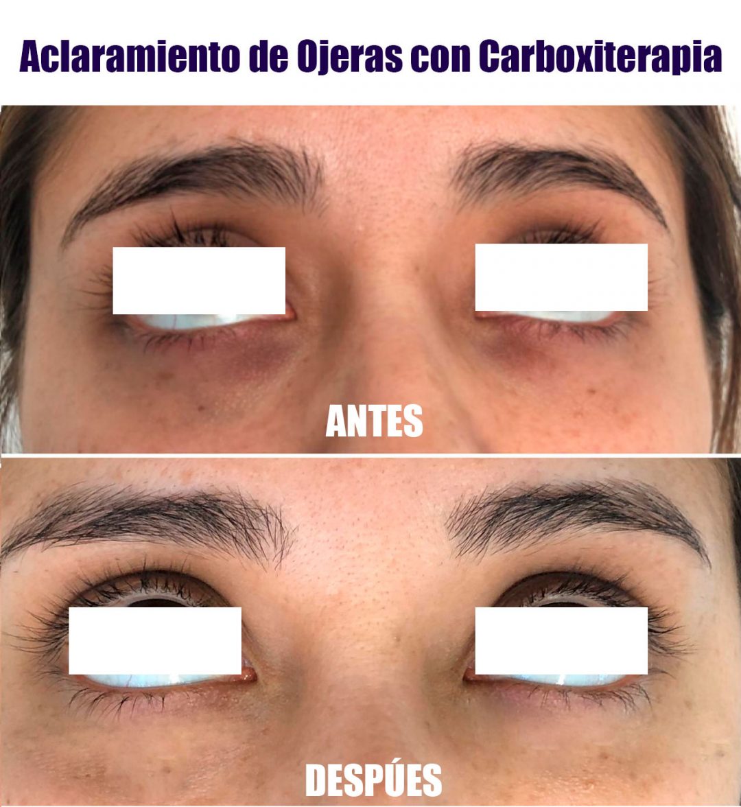 Carboxiterapia para ojeras - www.kinesiologiaestetica.cl