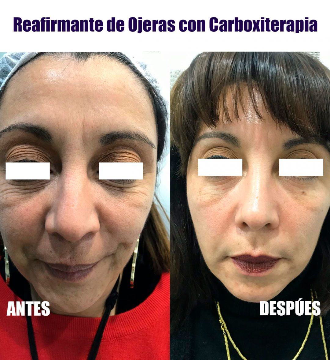 Carboxiterapia para ojeras - www.kinesiologiaestetica.cl