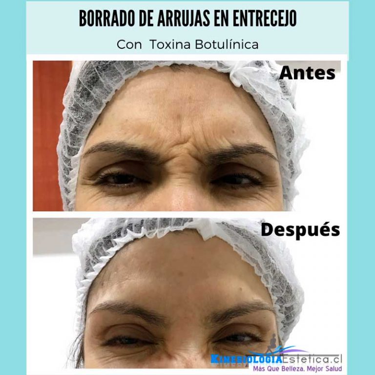 botox-entrecejo-antes-y-despues - www.kinesiologiaestetica.cl